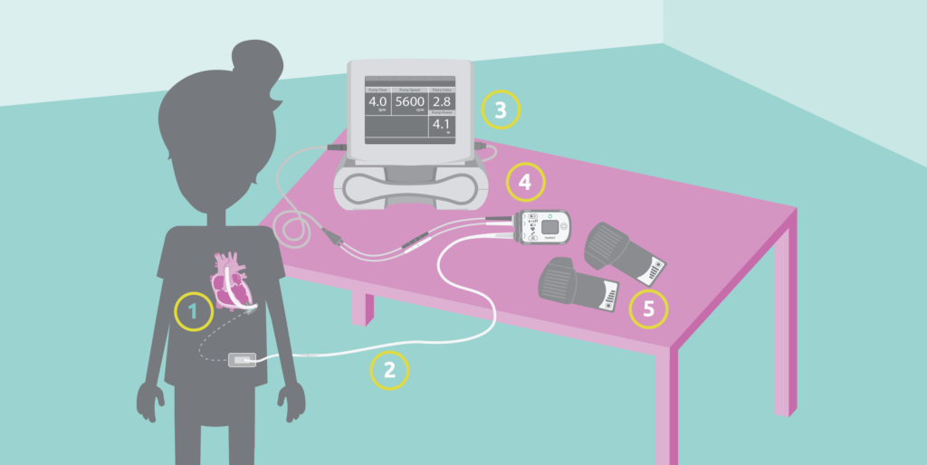 HeartMate 3 Device Components – myactioneducation.org