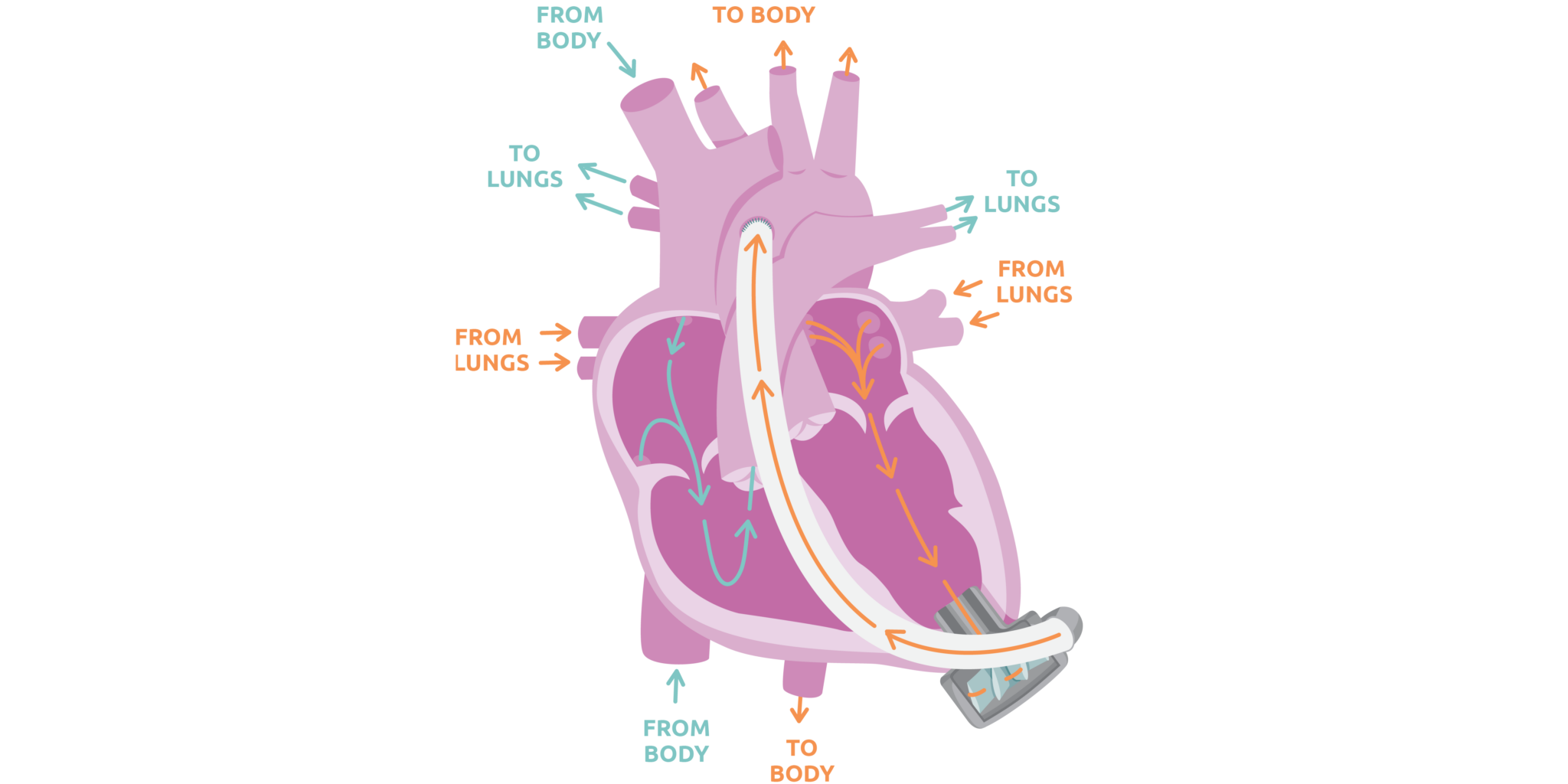 HeartMate 3 Device Components – myactioneducation.org