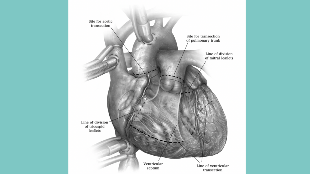 SynCardia (TAH-t) Extra Credit – myactioneducation.org